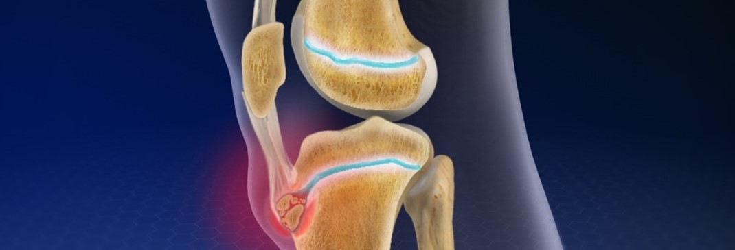 Osgood-Schlatter’s Disease | Central Performance