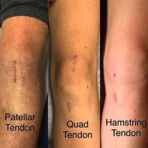 ACL Knee Injury - Surgery Or Not? | Central Performance